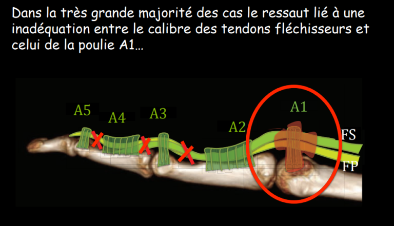 DOIGT À RESSAUT et ECHO CHIRURGIE - echo38